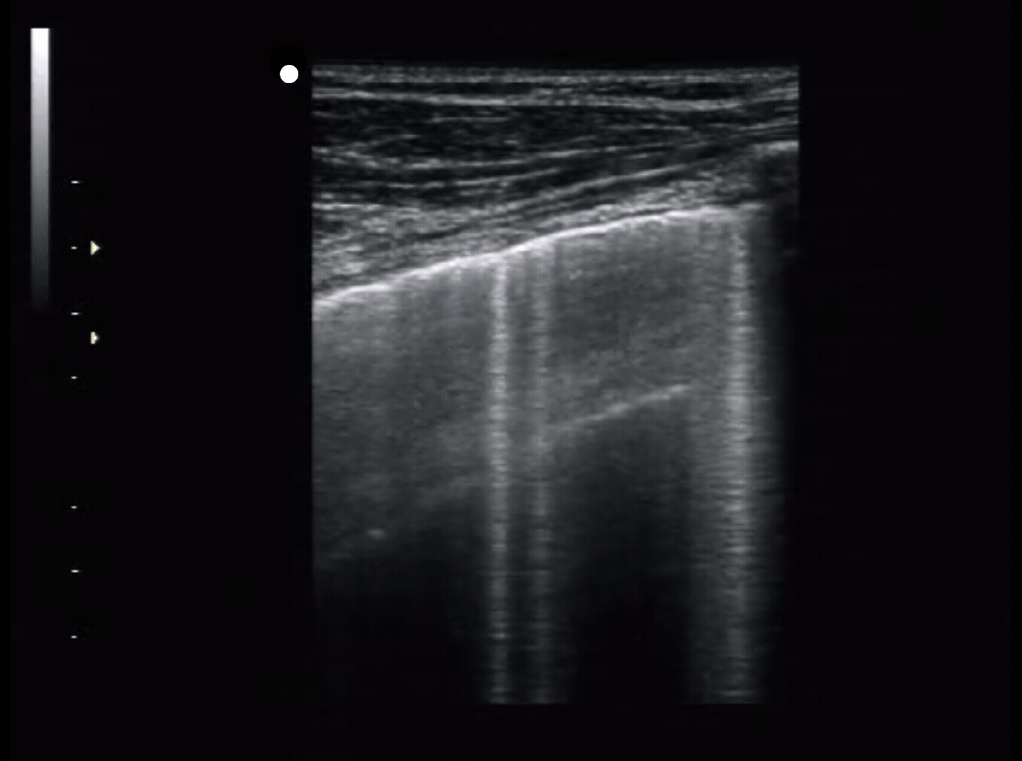 Lung Ultrasound for Evaluation of Extravascular Fluid in Hemodialysis ...